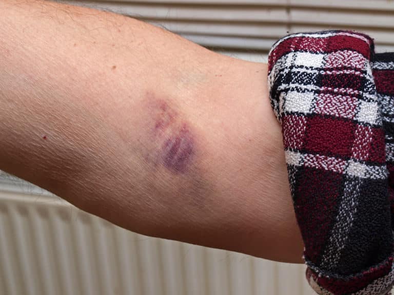 Ljubičaste fleke na koži (12 najčešćih uzroka i liječenje)